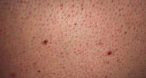 Keratosis Pilaris or chicken skin : All you need to know about this ...