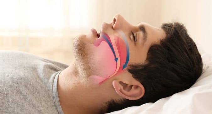 Floppy eyelids may be an indication of sleep apnoea | TheHealthSite.com