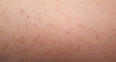 Ingrown hair: 6 reasons you're getting them! | TheHealthSite.com