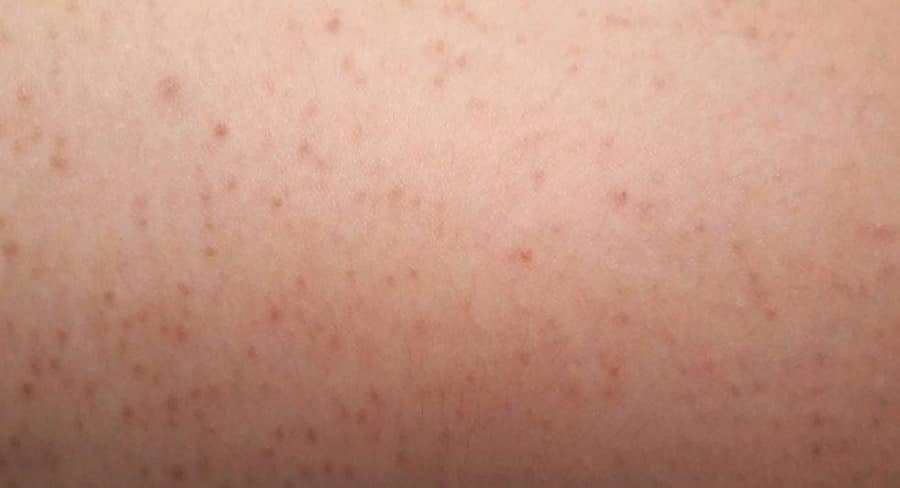 Ingrown hair: 6 reasons you're getting them! | TheHealthSite.com