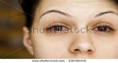 Not just lungs, tuberculosis affects your eyes as well | TheHealthSite.com