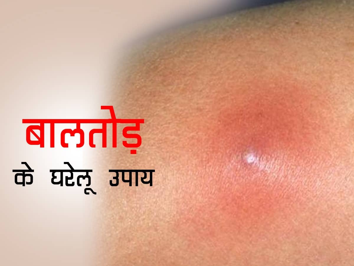 बालतोड़ क्यों होता है? जाने इसके 5 बेहतरीन घरेलू उपचार | TheHealthSite ...