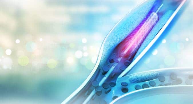 Everything you need to know about angioplasty and stent replacement ...
