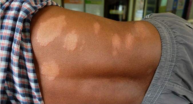 A look at leprosy in India: Watch out for these top symptoms to start ...