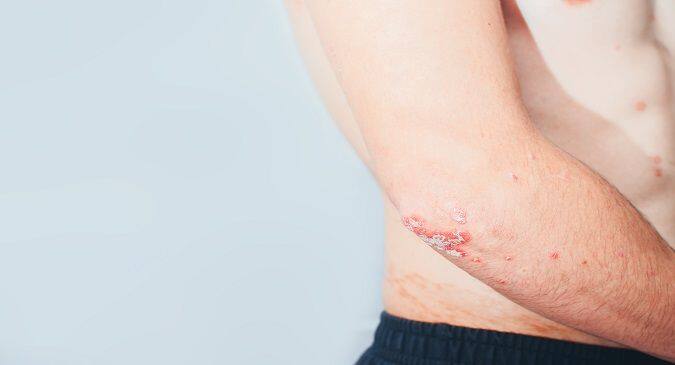 World Psoriasis Day: 4 simple hacks of tackling psoriasis induced ...