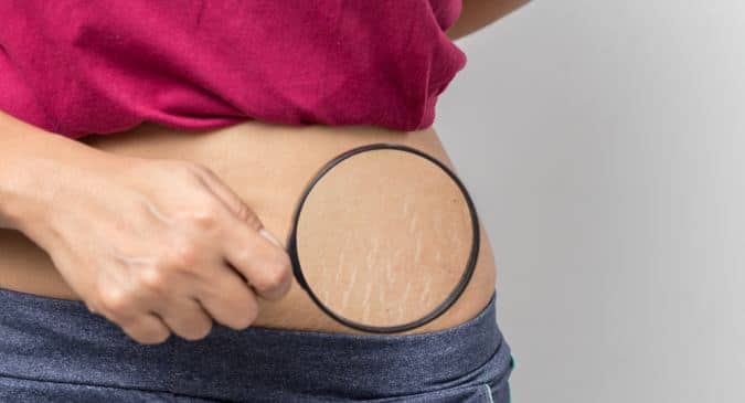 Everything you needed to know about stretch marks! | TheHealthSite.com