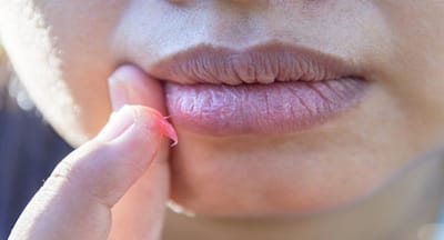 Tips to get rid of white spots on lips | TheHealthSite.com
