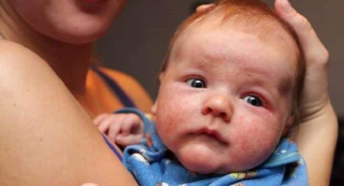 6 few tips to combat atopic dermatitis in babies | TheHealthSite.com