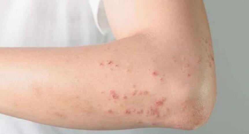 World AIDS Day: Chronic Cough And Other Warning Signs of An HIV ...