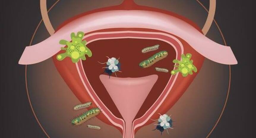 Want to prevent bladder cancer? Know its causes first | TheHealthSite.com