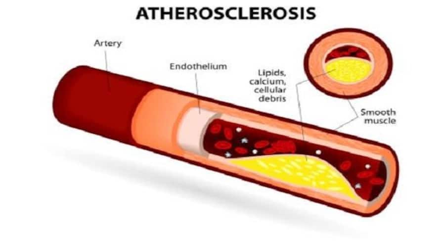 atherosclerosis: Know all about it %%page%% %%sep%% TheHealthSite.com ...