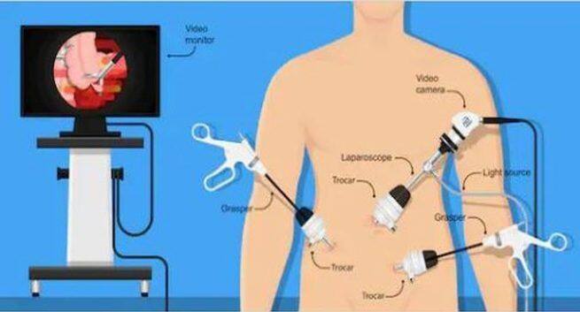 Laparoscopic Surgery जानें क्या है लेप्रोस्कोपिक सर्जरी कैसे करती है काम