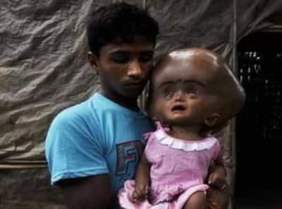 Baby Roona Begum successfully treated for hydrocephalus | TheHealthSite.com