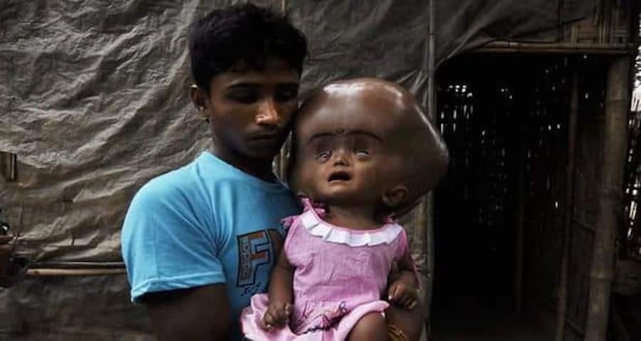Baby Roona Begum undergoes surgery for hydrocephalus - will she be able ...