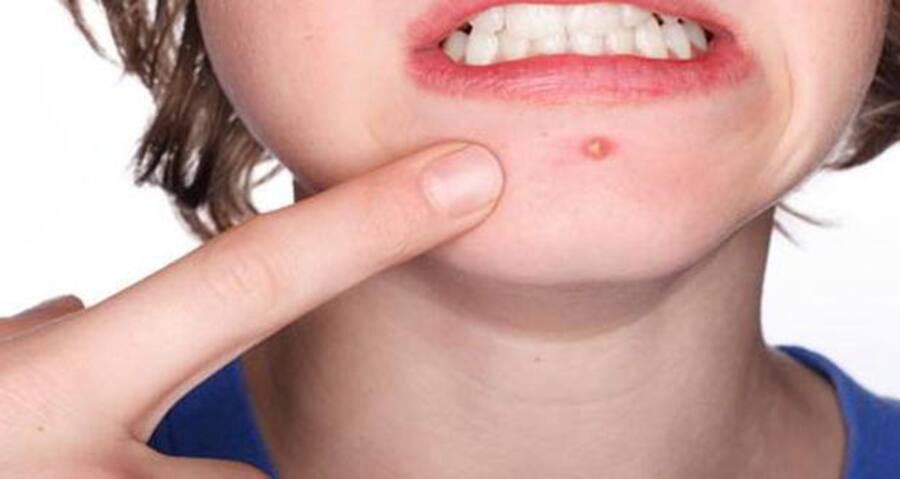 Skin virus to cure acne? | TheHealthSite.com