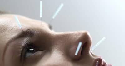 Acupuncture - 10 facts you should know about this ancient Chinese ...