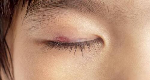 Blepharitis – causes, symptoms, diagnosis, treatment and prevention ...