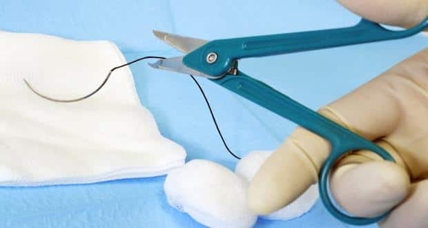 New study favors sutures over staples for closing a C-section incision ...