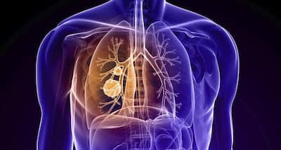 Basic cancer treatments: Surgery, Chemotherapy, Radiotherapy and Bone ...