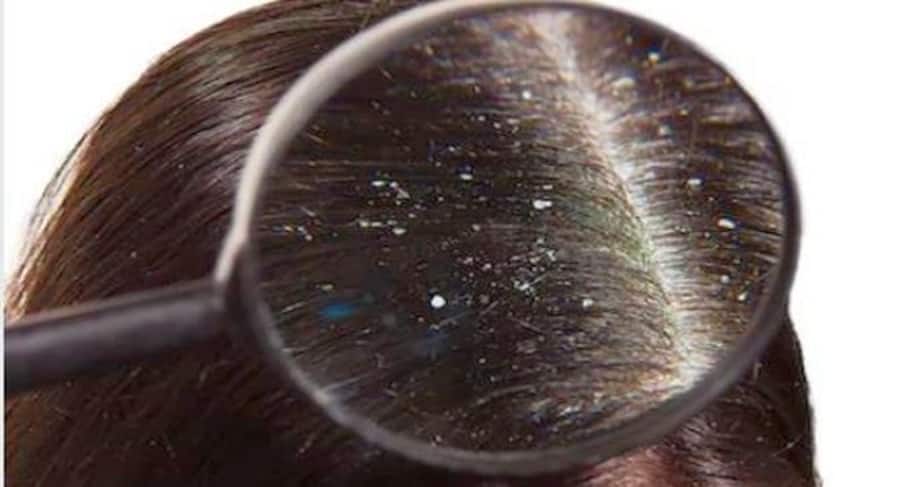 How to treat dandruff with natural remedies at home? | TheHealthSite ...