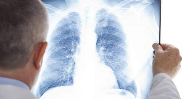 Lung disease -- causes, types, symptoms, diagnosis, treatment and ...