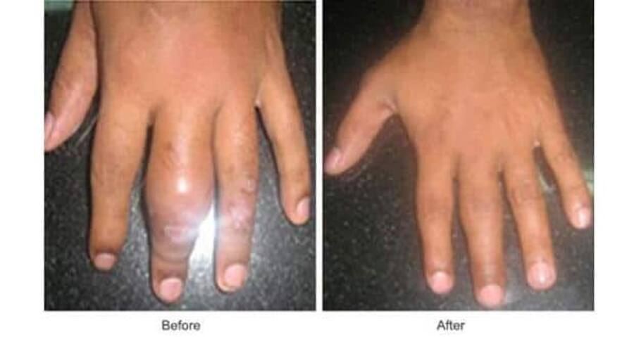 Treatment and self-care for psoriasis | TheHealthSite.com