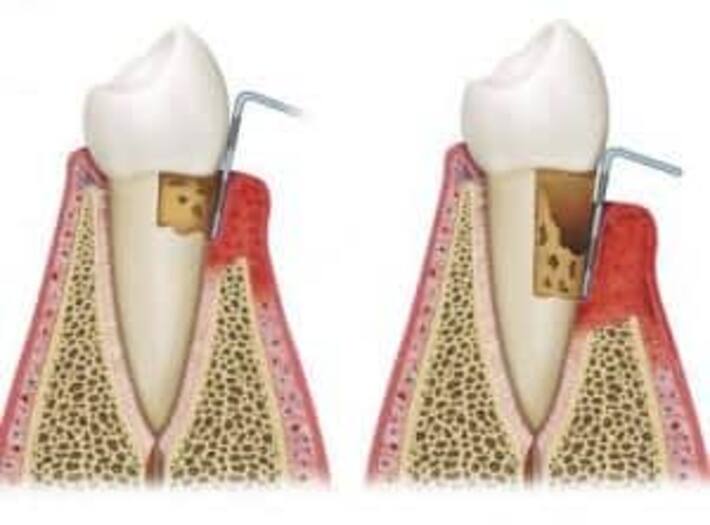 When roots of the teeth are affected by decay | TheHealthSite.com