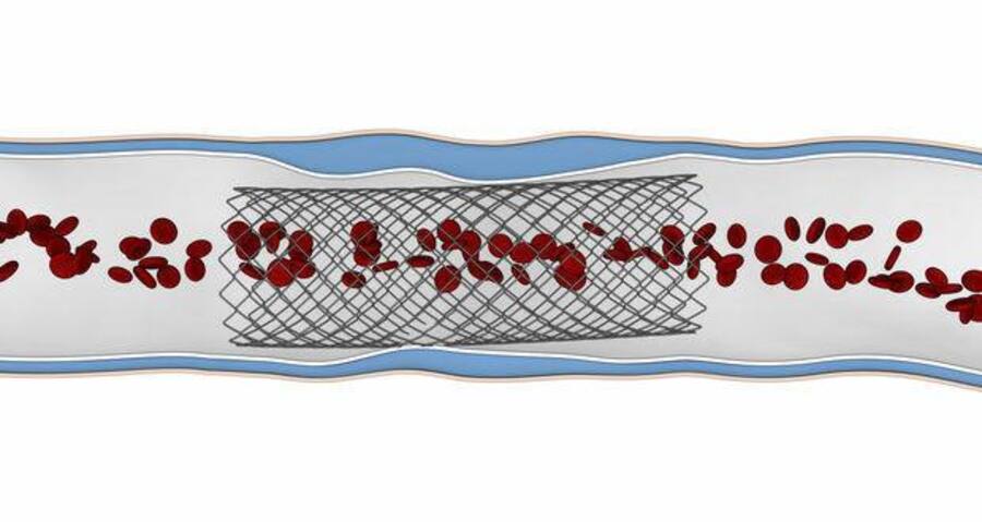 Bioabsorbable stents – the future of angioplasty? | TheHealthSite.com