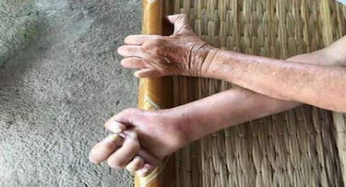 Leprosy - know about the complications %%page%% %%sep%% TheHealthSite ...