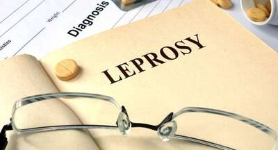 Leprosy - know the facts about this disease | TheHealthSite.com
