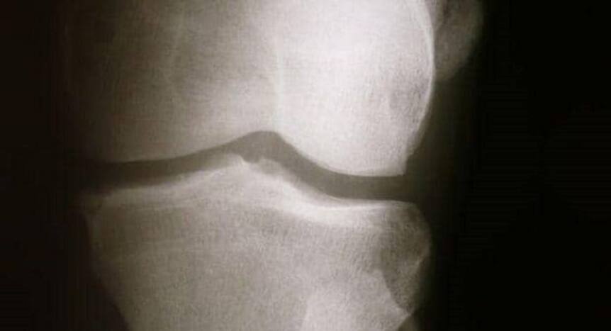 Cartilage - protect it with the right foods %%page%% %%sep ...