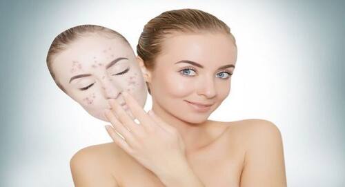 Melasma: Symptoms, Prevention And Treatment For This Skin Condition ...