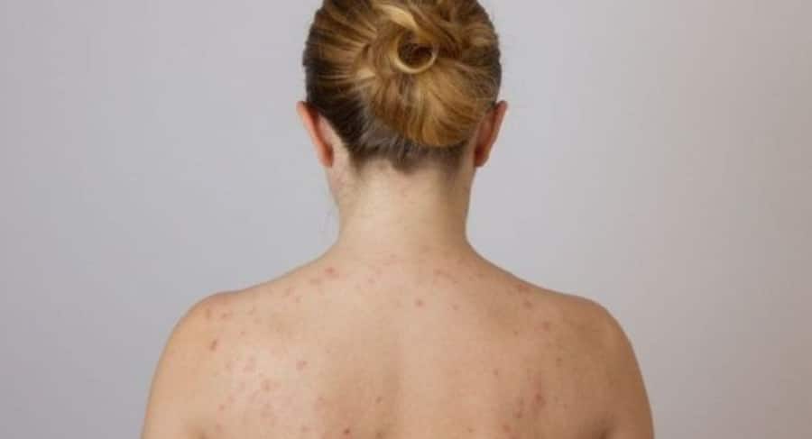 Wearing tight clothing in summer can cause folliculitis | TheHealthSite.com