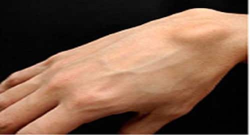 Lipomas: Home remedies to get rid of that lump just under your skin ...