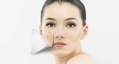 Cystic acne: Dermatologist explains how it can be treated ...