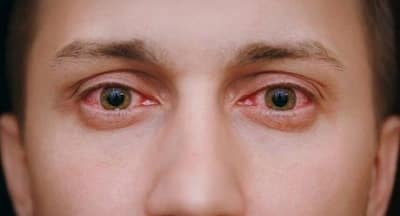 What causes red eyes and 5 home remedies to get rid of it ...