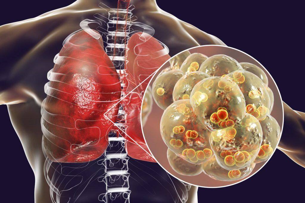 DNA Test Can Identify Pneumonia In Patients With Severe Covid 19