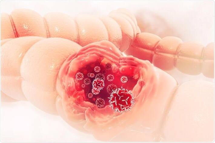 Rare types of cancer and their symptoms you should know | TheHealthSite.com