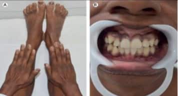 Genes responsible for autoimmune Addison's disease discovered