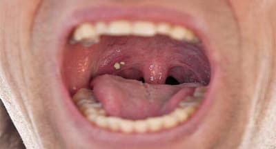 Tonsil Stones: टॉन्सिल में पथरी से सूजता है गला, इन 5 लक्षणों से ...