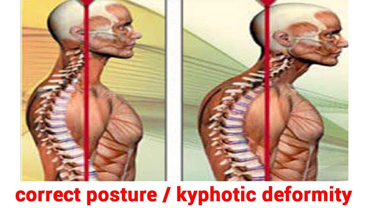 Kyphotic deformity: A real risk for post-menopausal women ...