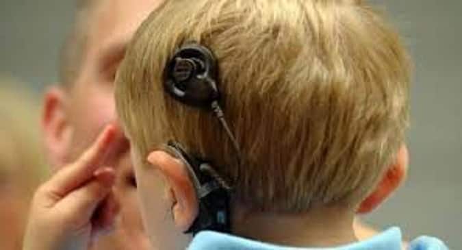 Cochlear implants for hearing loss: The recipients share their ...