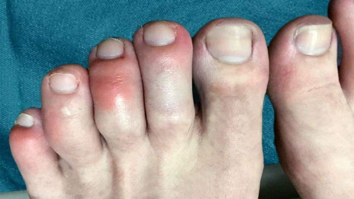 Covid toes know who is more susceptible of this prominent symtom of ...