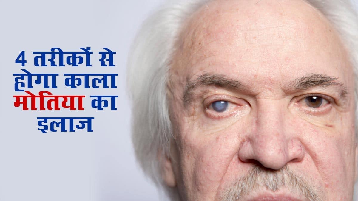 Glaucoma (Kala Motia): 4 तरीकों से ठीक किया जा सकता है काला मोतिया ...