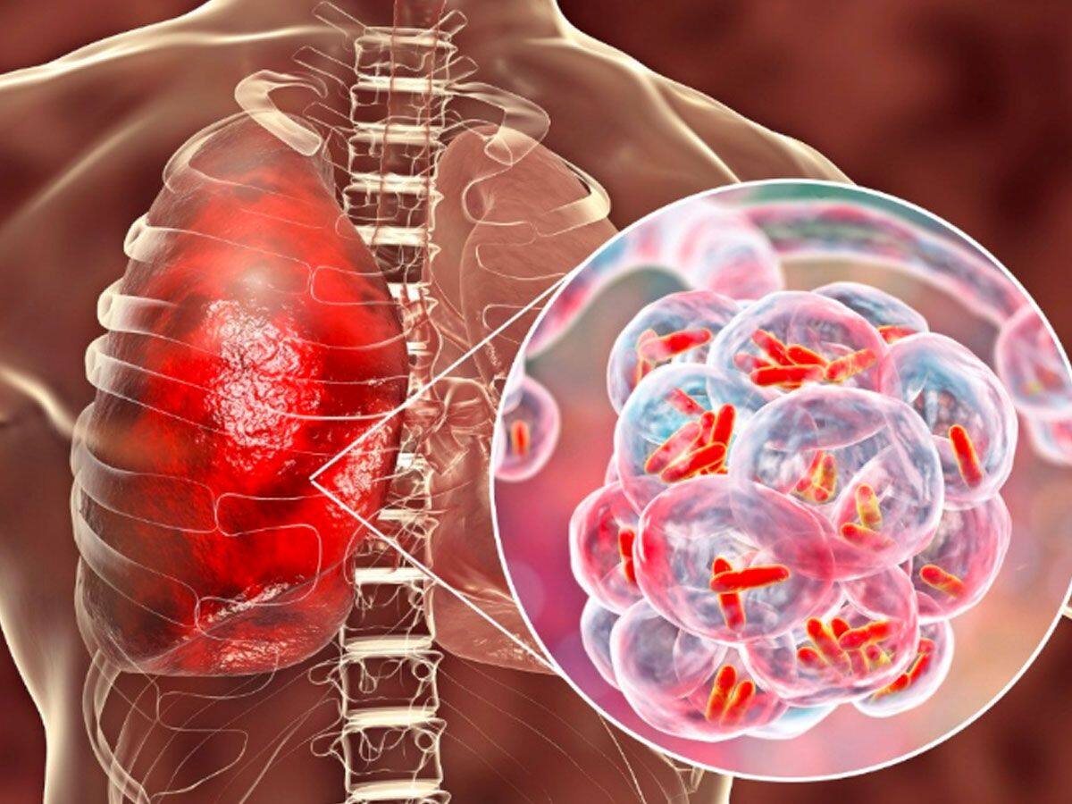 Women With COVID-19 Pneumonia At Higher Risk Of Lung Damage: Lancet ...