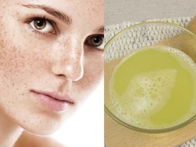 Pigmentation (Jhaiya) On Face | चेहरे से झाइयां और दाग-धब्‍बे हटाने के ...