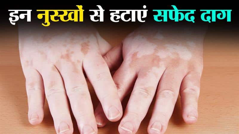 Home Remedies For White Spot: सीनियर डॉक्‍टर ने बताया सफेद दाग के लिए ...