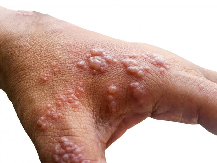 Rare Monkeypox Cases Reported from US, First Time In Nearly 20 Years ...