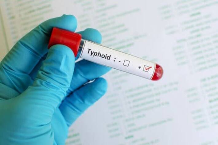 Typhoid Diet: Foods You Should Eat And Avoid When Suffering From ...