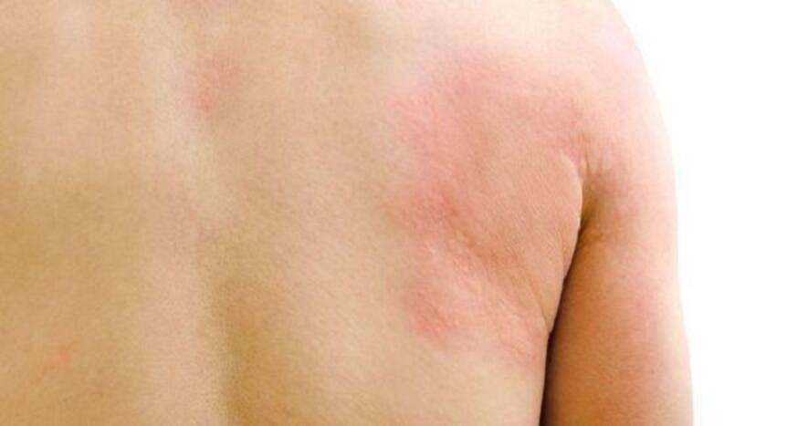 Frequent Infections, Breathlessness And Other Common Blood Cancer ...